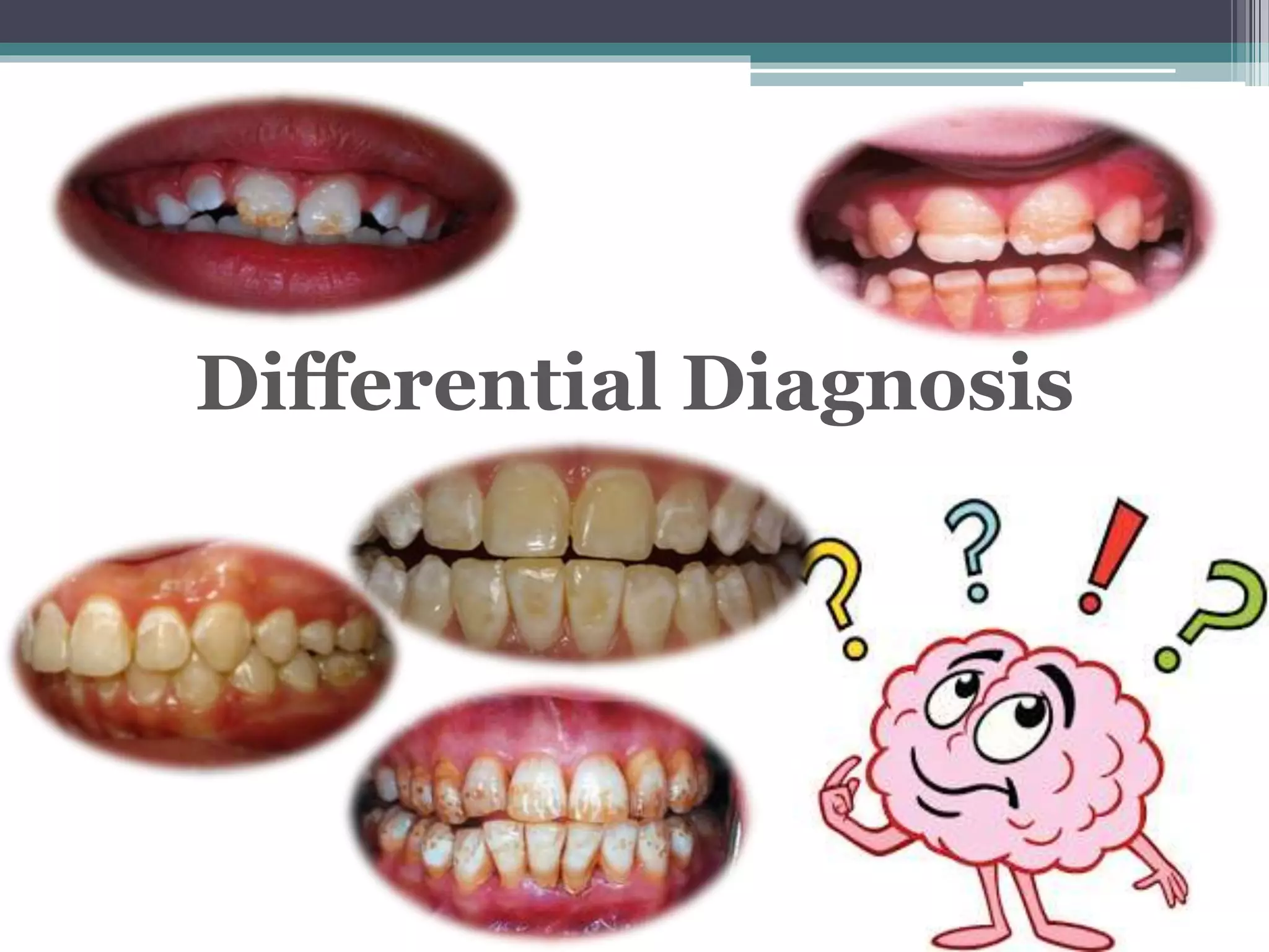 Molar incisor hypomineralization | PPTX