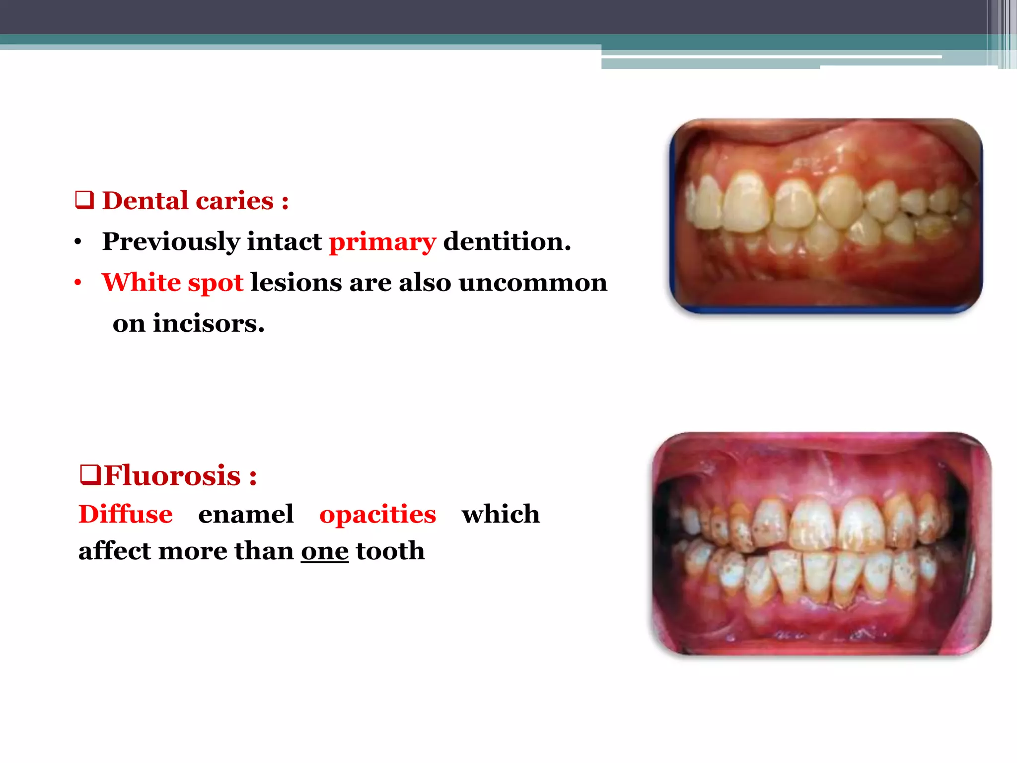Molar incisor hypomineralization | PPTX