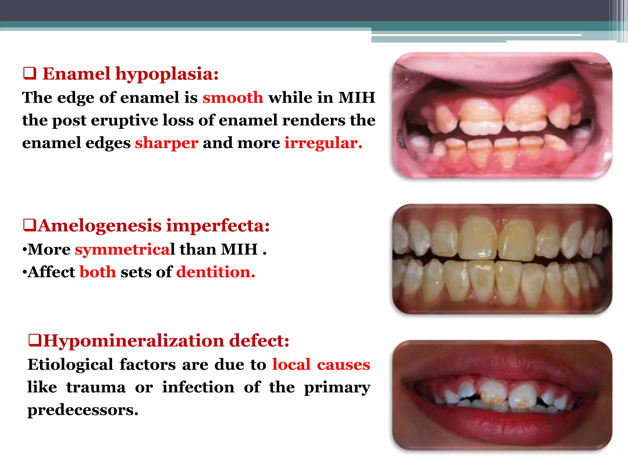 Molar incisor hypomineralization | PPTX