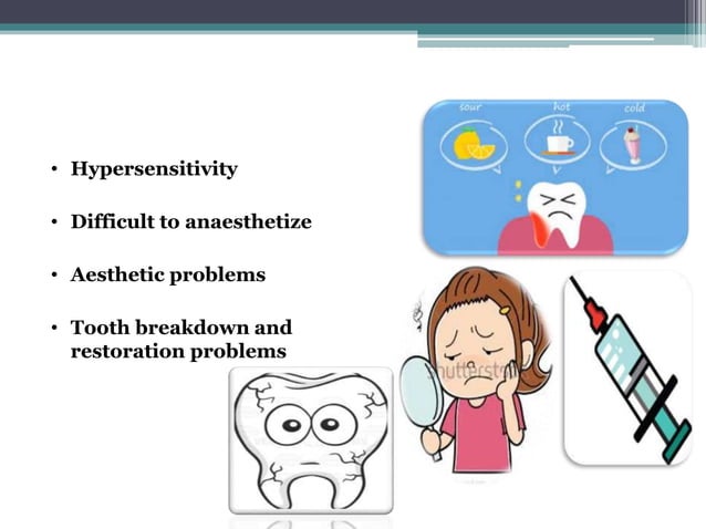 Molar Incisor Hypomineralization Pptx