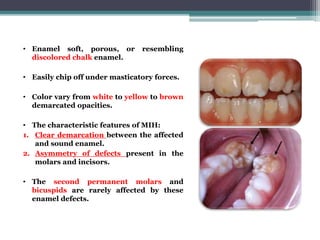 Molar incisor hypomineralization | PPTX