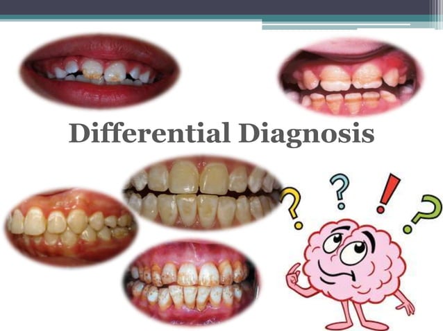 Molar incisor hypomineralization | PPTX