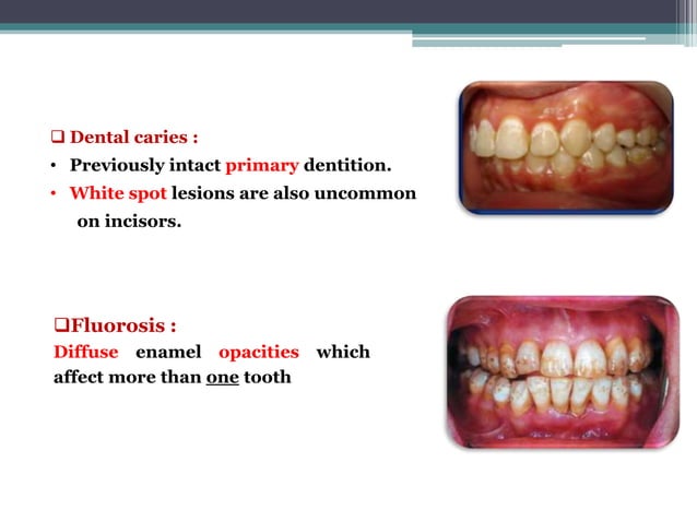 Molar Incisor Hypomineralization Pptx