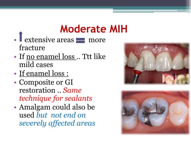 Molar incisor hypomineralization | PPTX