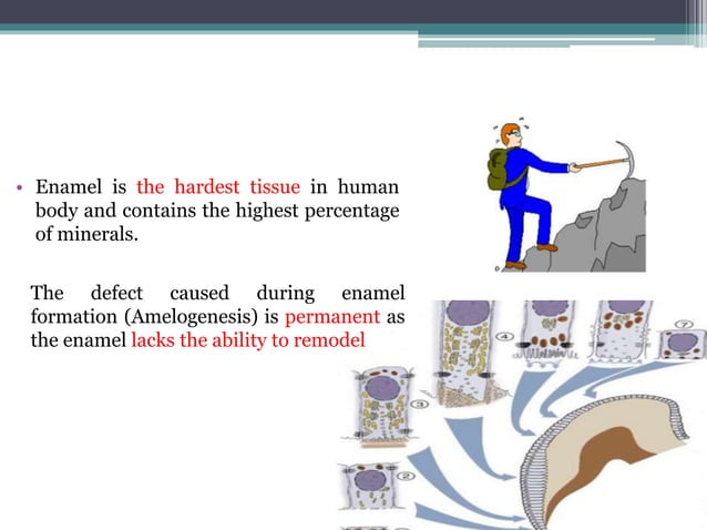 Molar Incisor Hypomineralization Pptx