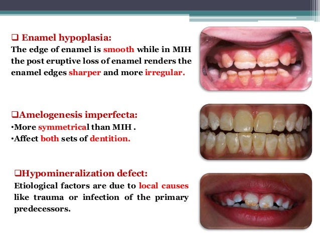 Enamel Hypomineralization Treatment Bauer Smiles
