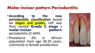 Noval treatment approach of Molar Incisor Pattern PERIODONTITIS ...