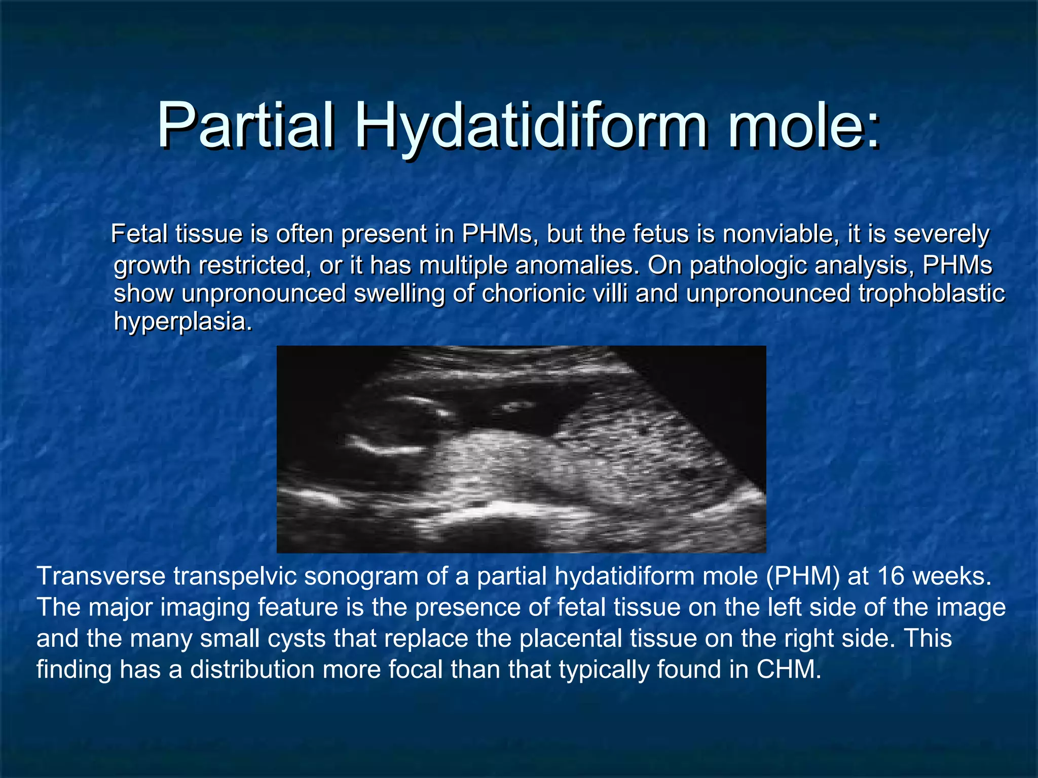 Molar pregnancy | PPT