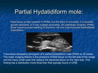 Molar pregnancy | PPT