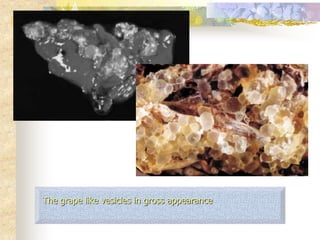 Molar pregnancy | PPTX