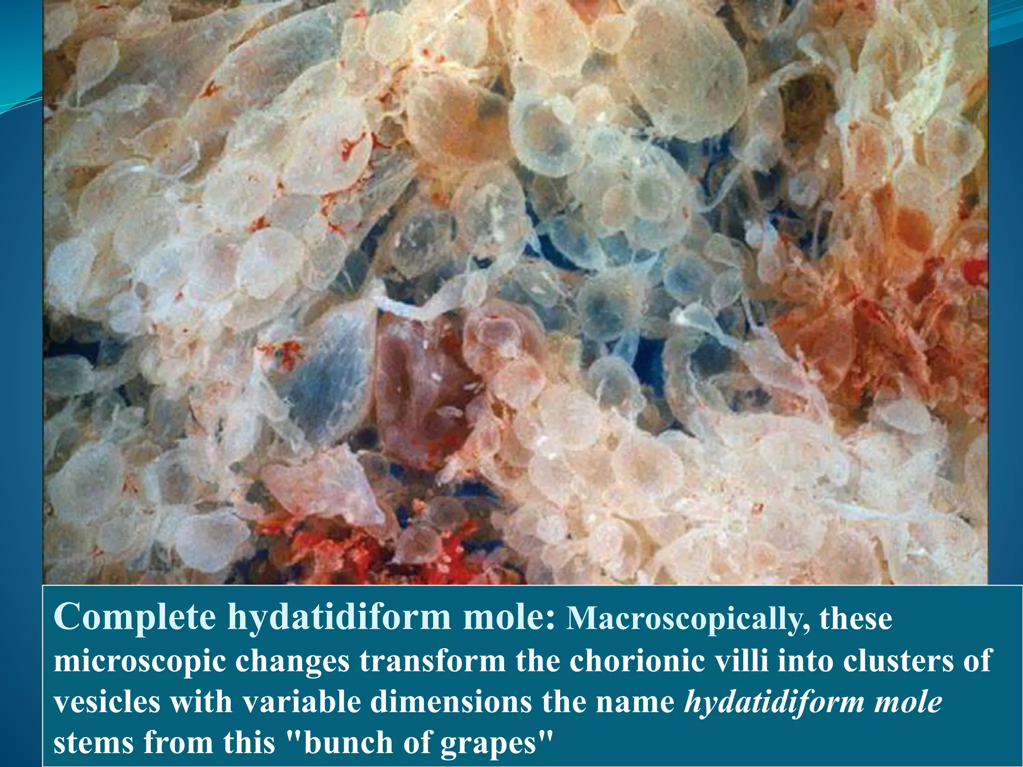 Molar pregnancy | PPTX