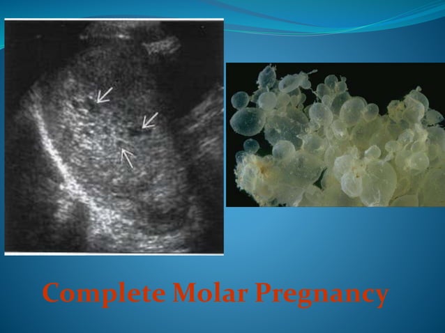 Molar pregnancy | PPTX | Pregnancy | Reproductive Health
