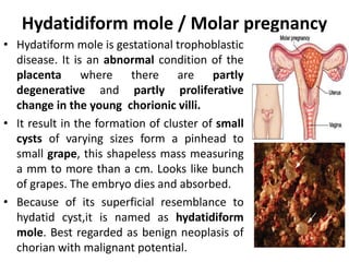 molar pregnancy.pptx