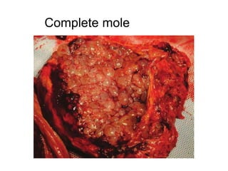 Molar Pregnancy Complete Vs Incomplete Hydatidiform Mole.pptxpptx | PPTX