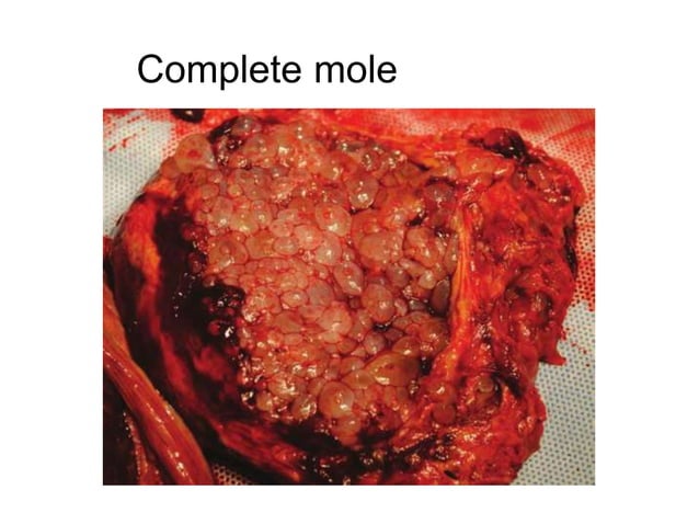 Molar Pregnancy Complete Vs Incomplete Hydatidiform Mole.pptxpptx | PPTX