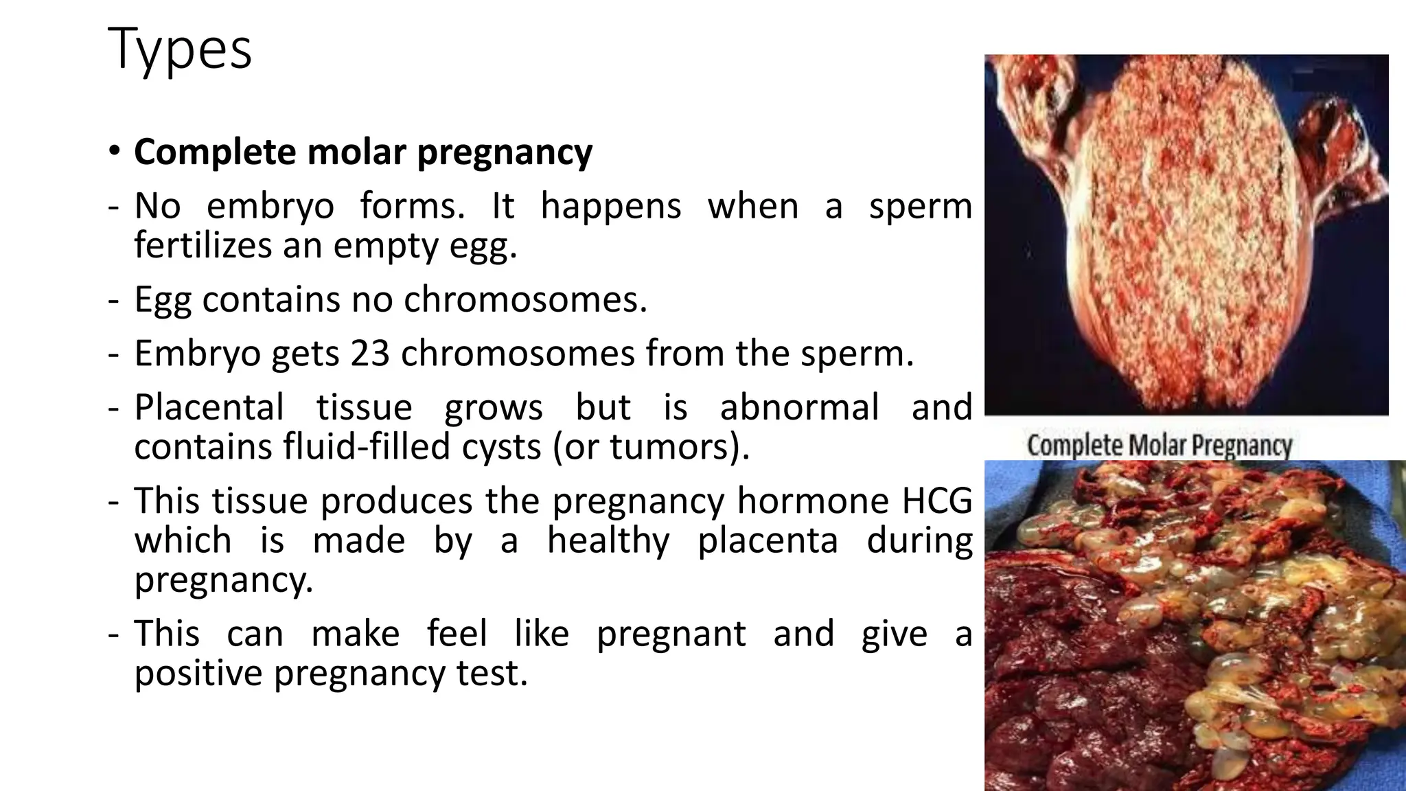 A lecture slide of Molar Pregnancy.pptx for Students | PPTX