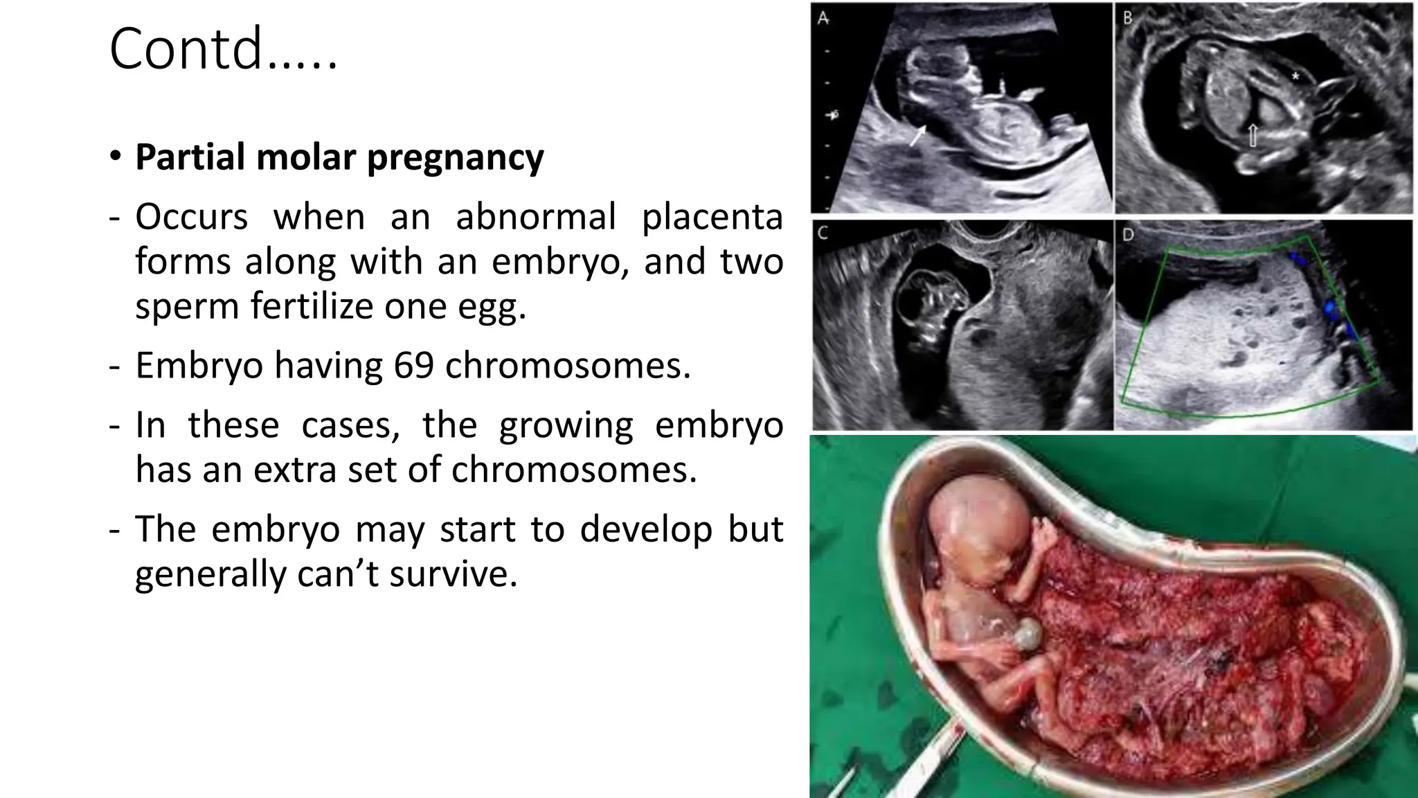 A lecture slide of Molar Pregnancy.pptx for Students | PPT