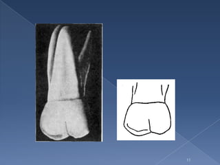 Primer molar superior | PPTX