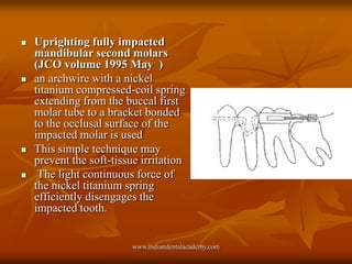 Molar uprighting | PPT