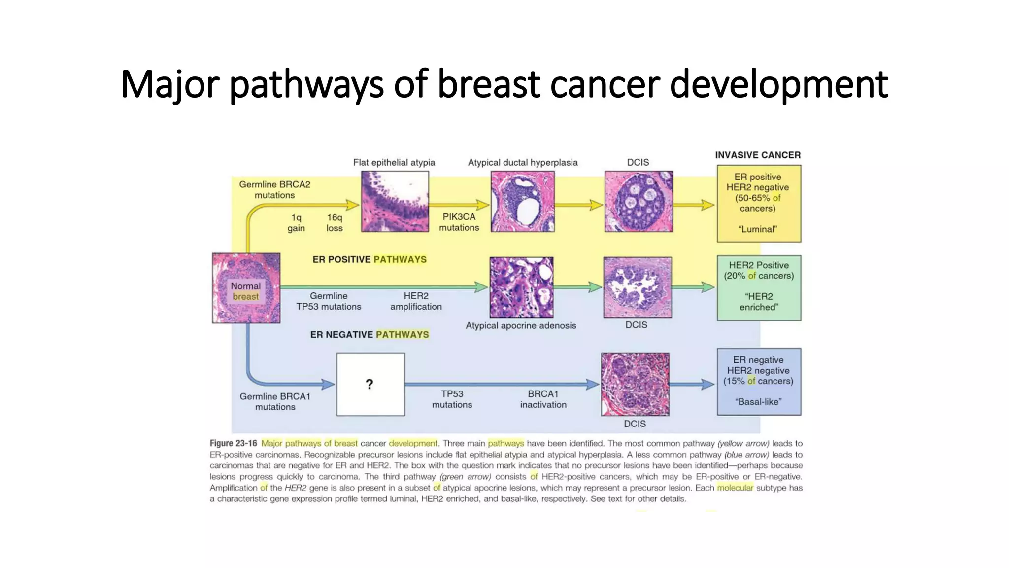 Molecular classification breast carcinoma | PPTX