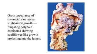 Molecular basis and etiopathogenesis of colorectal carcinoma.pptx