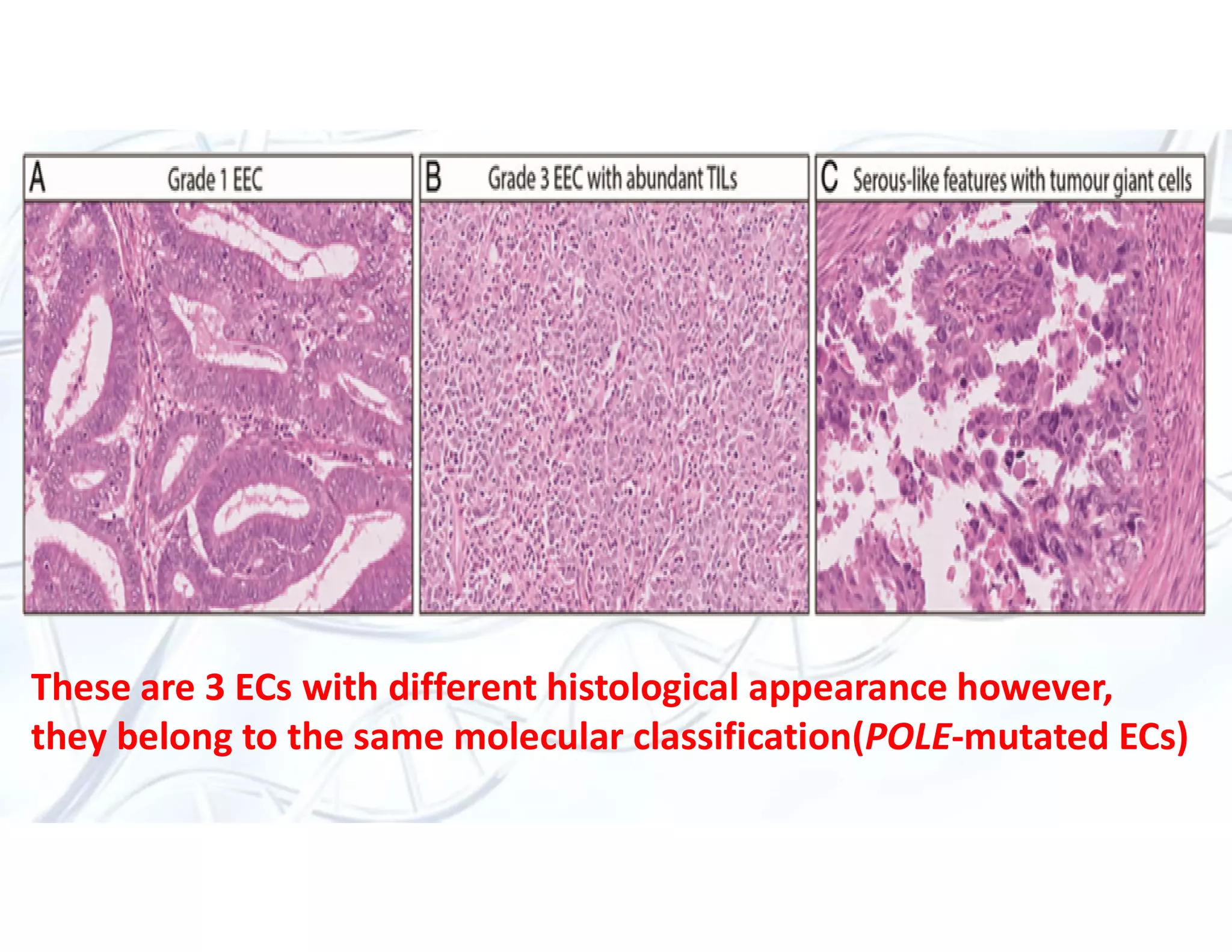 Molecular classification of endometrial cancer | PDF
