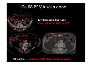 Molecular imaging and therapy in prostate cancer | PPT
