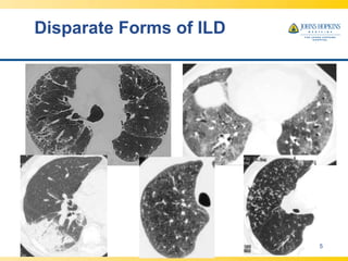 Molecular Mechanisms in ILD in Adult Connective Tissue Disease | PPT ...