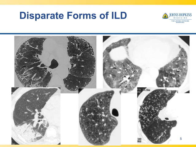 Molecular Mechanisms in ILD in Adult Connective Tissue Disease | PPT ...