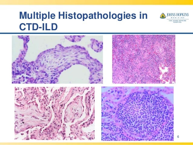 Molecular Mechanisms in ILD in Adult Connective Tissue Disease