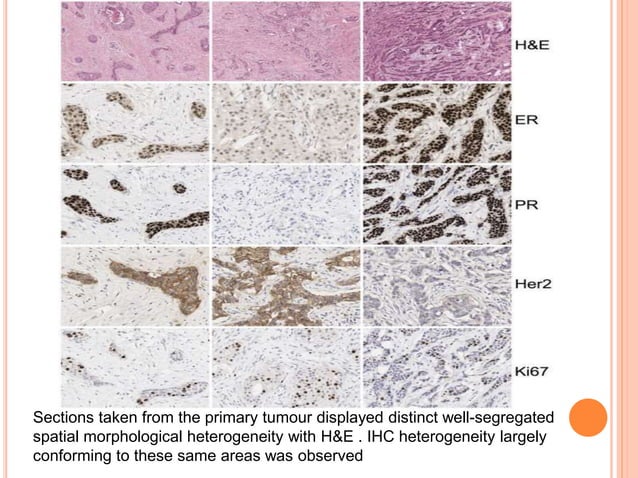 Molecular profiling of breast cancer | PPTX | Cancer | Diseases and ...