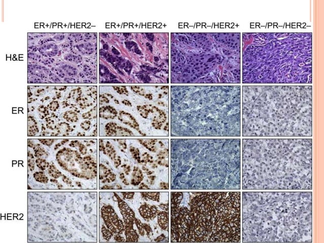 Molecular profiling of breast cancer | PPTX | Cancer | Diseases and ...