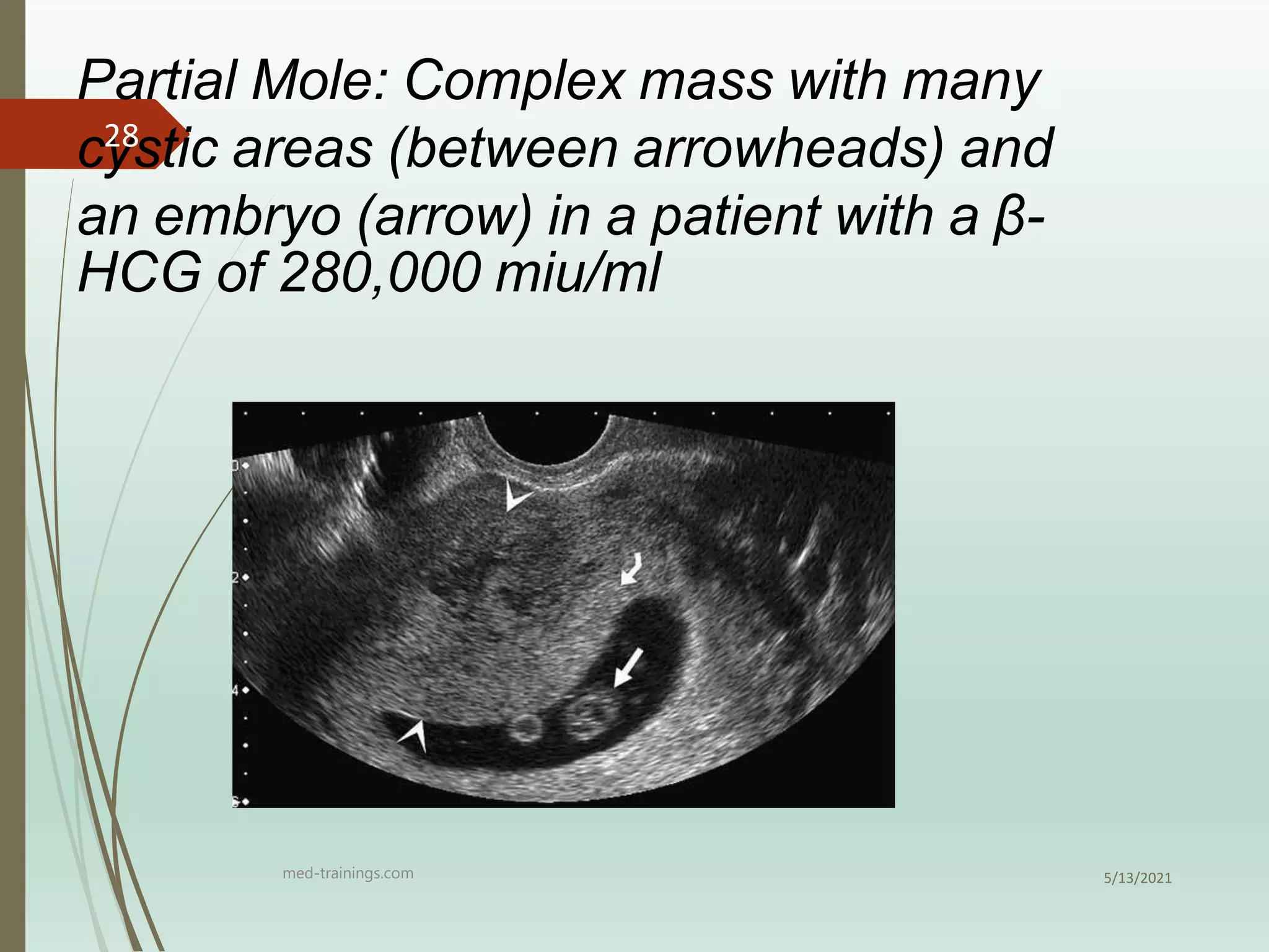 Molar Pregnancy | PPT