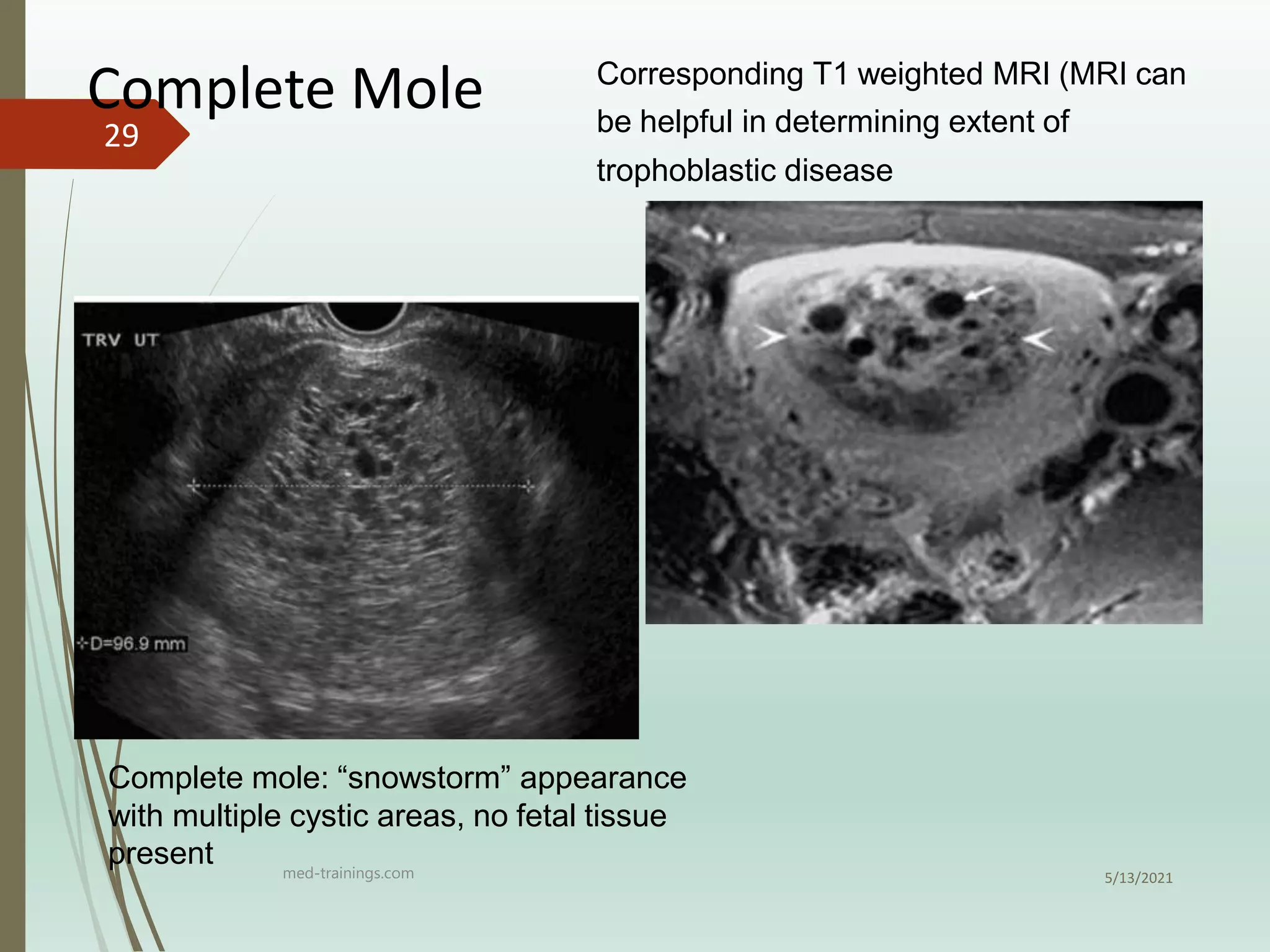 Molar Pregnancy | PPT