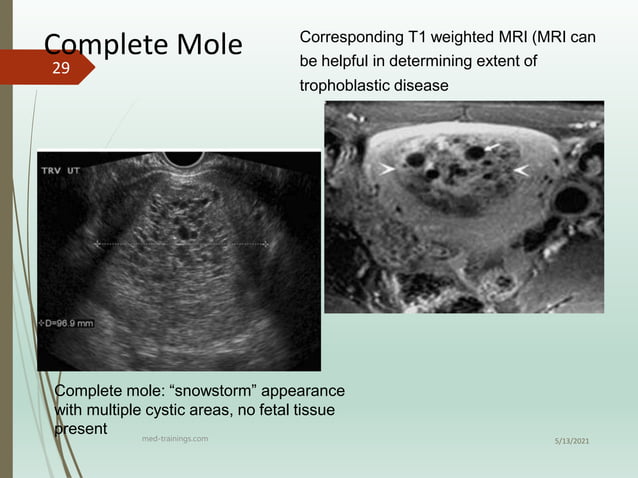 Molar Pregnancy | PPT