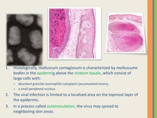 Molluscum-contagiosum cfuk | PPT