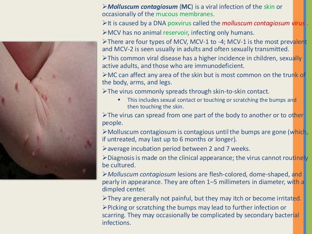 Molluscum-contagiosum cfuk