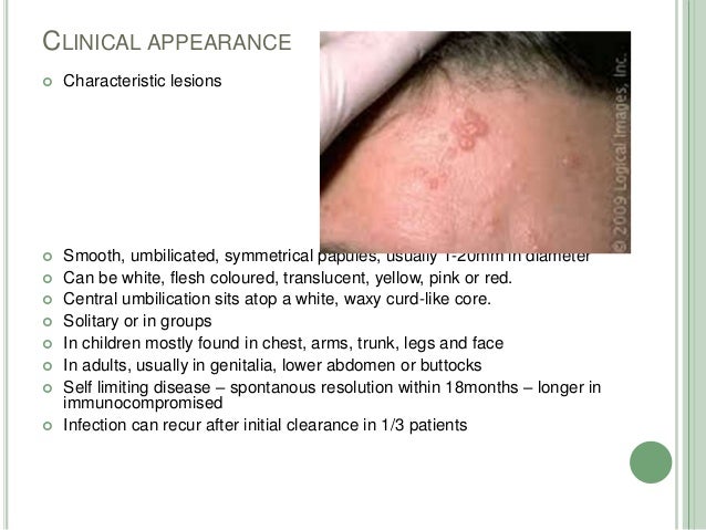 Molluscum Contagiosum Groin