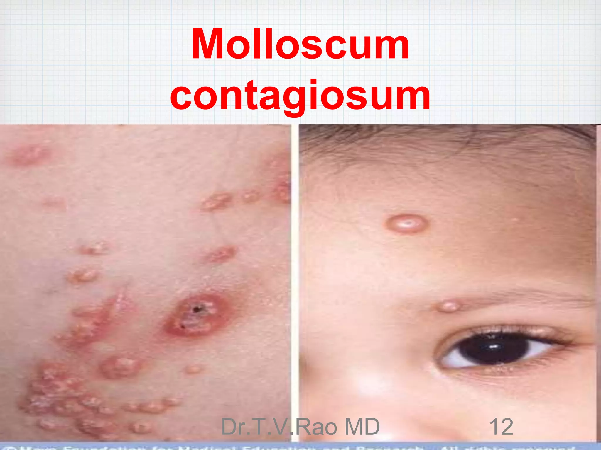 Molluscum contagiosum | PPTX