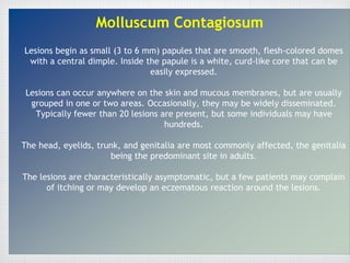 Molluscum contagiosum | PPTX