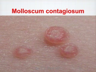 Molluscum contagiosum | PPTX