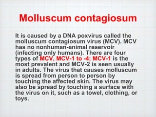 Molluscum Contagiosum: Epidemiology, Pathogenesis, Clinical, 44% OFF