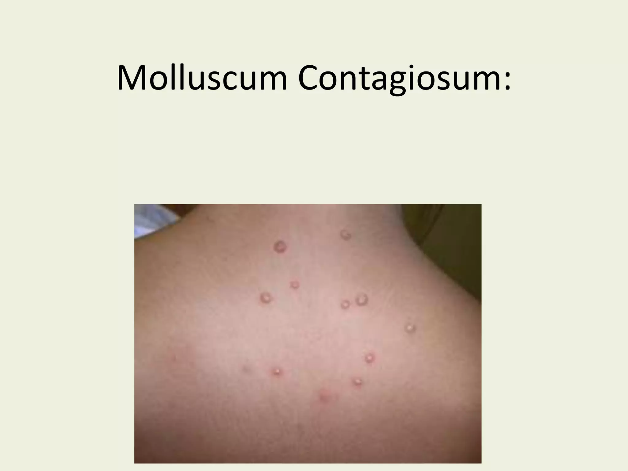 Molluscum contagiosum Made Extremely Simple | PPTX
