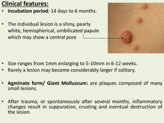 Molluscum contagiosum Made Extremely Simple | PPTX