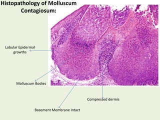 Molluscum contagiosum Made Extremely Simple | PPTX