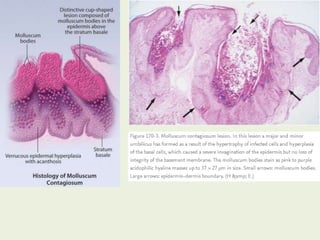 Molluscum Contagiosum Histology