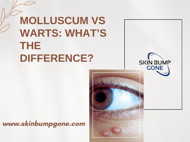 Molluscum vs warts What’s The Difference | PDF | Skin and Dermatology ...