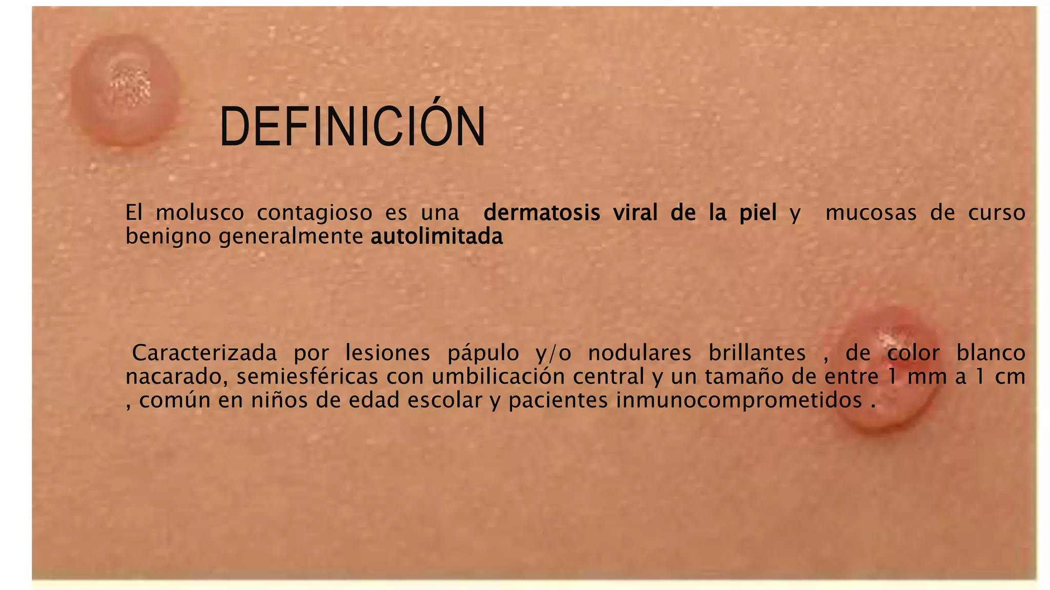 MOLUSCO CONTAGIOSO | PPTX