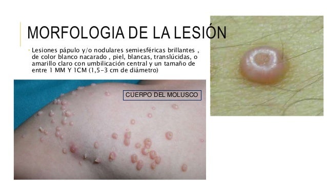 MOLUSCO CONTAGIOSO