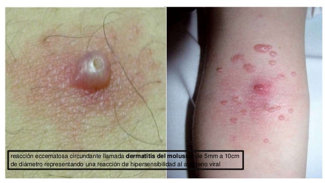 MOLUSCO CONTAGIOSO